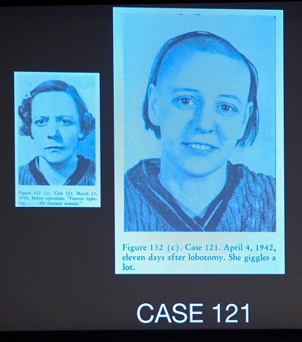 When Faces Made the Case for Lobotomy | NIH Record